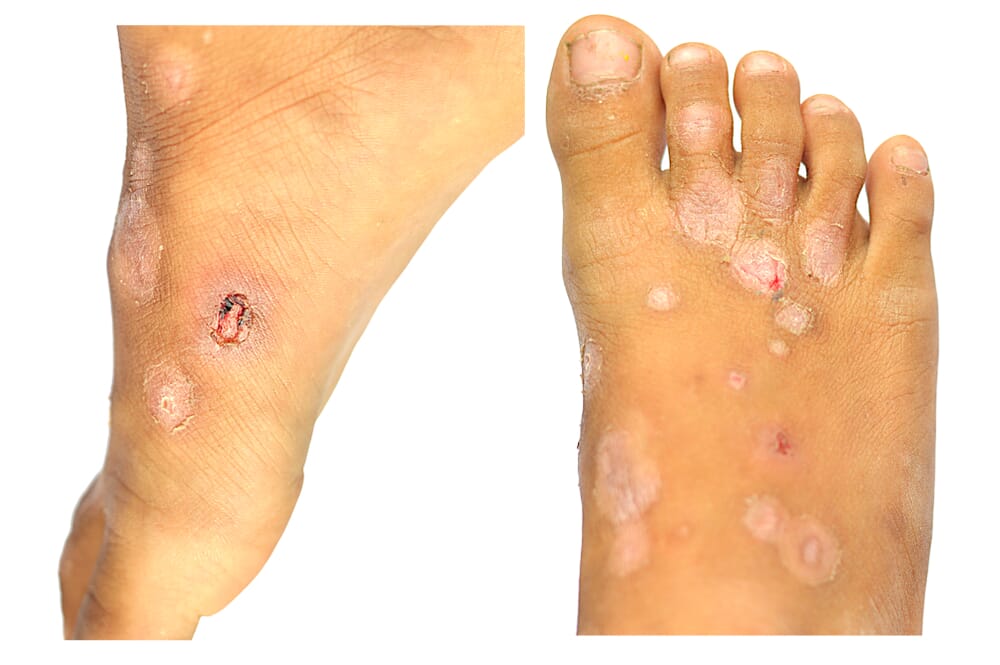 Désinfection de la Gale La Fare Les Oliviers | DKM Experts